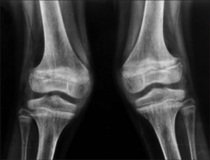 Genu Valgum - Treatment Options For Knocked Knees - EsHealthTips
