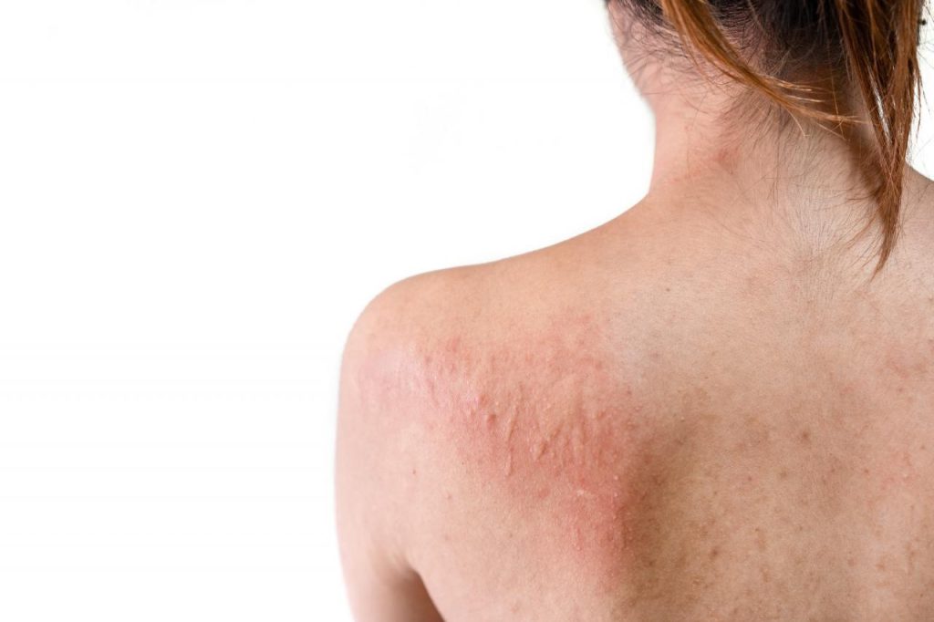 Symptoms Rash Back - What to Do If You Have a Rash - EsHealthTips