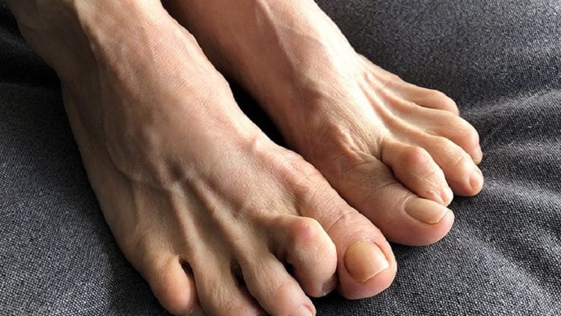 Diagnose Claw Toe Deformity - EsHealthTips