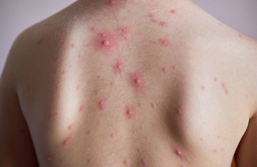 What Causes Circular Lesions On Skin EsHealthTips