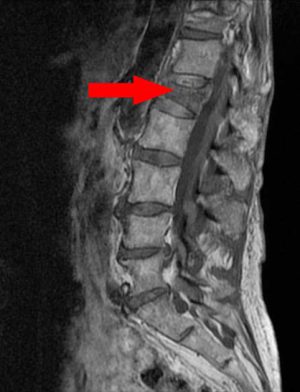 Treatments For Shattered Vertebrae - EsHealthTips
