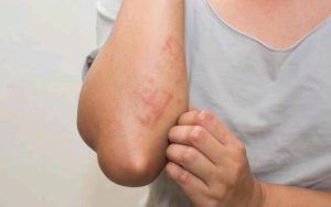 Diabetic Skin Lesions - Causes and Symptoms - EsHealthTips