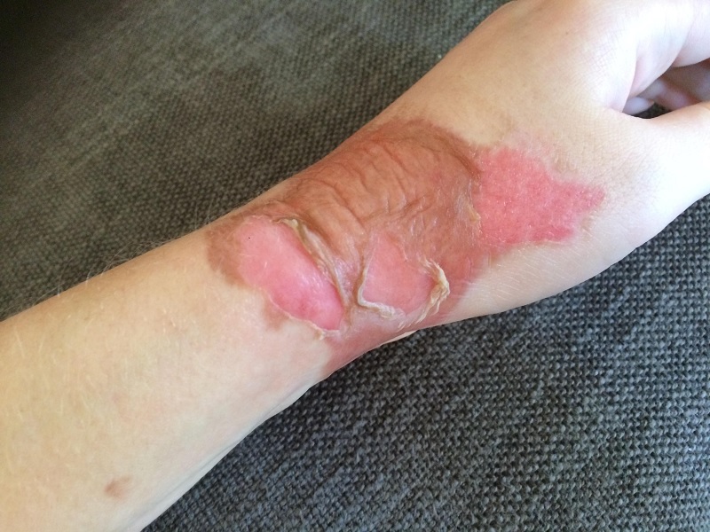 Deep Partial Thickness Burn EsHealthTips