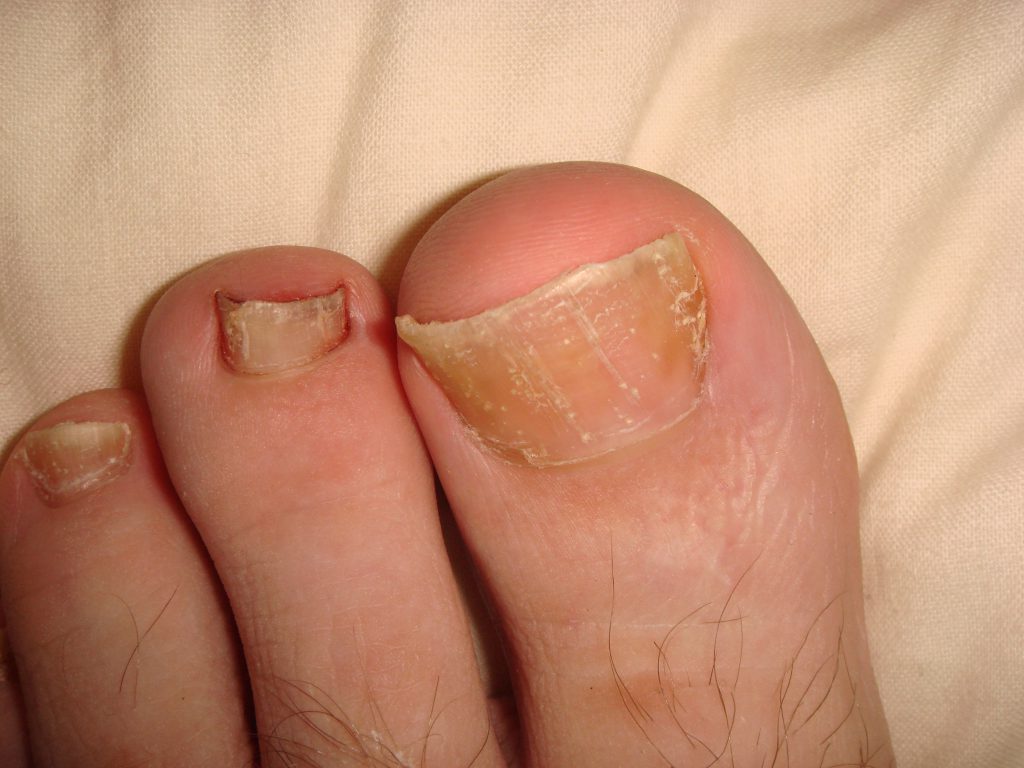 Symptoms of Psoriatic Arthritis Toenails - EsHealthTips