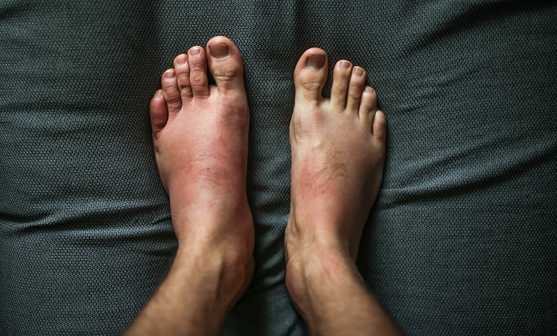 Symptoms of Psoriatic Arthritis Toenails - EsHealthTips